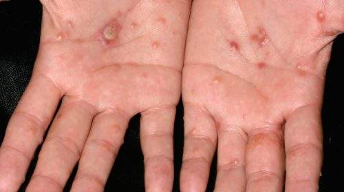 Tipuri de mucus - Ce spune culoarea mucoasei tale despre sanatatea ta